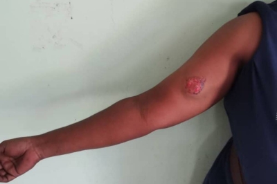 In Johor, man bites cop’s arm to escape after causing public ...