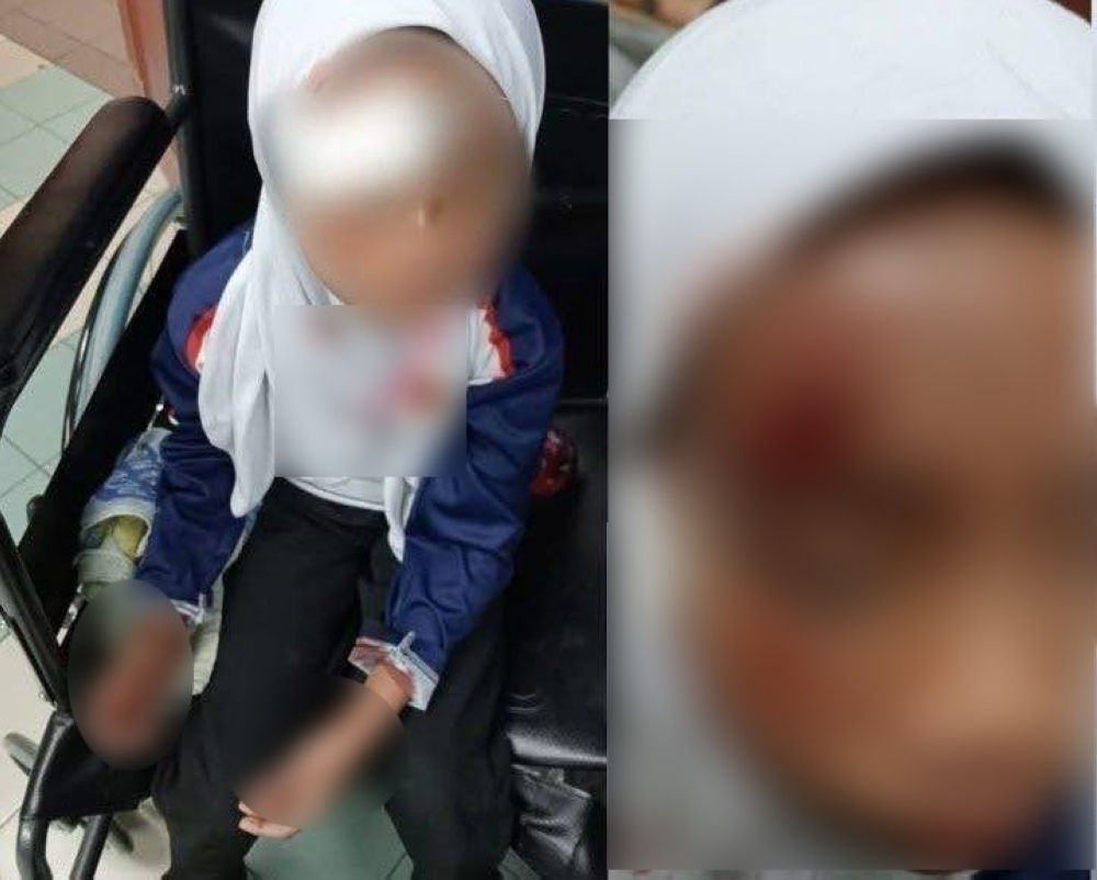 Melaka hit-and-run leaves young girl with deep gash on forehead, police ...